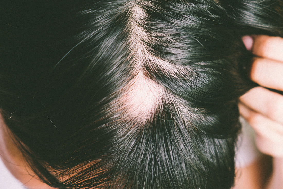 Alopecia Areata Treatment Toronto | FACET Dermatology